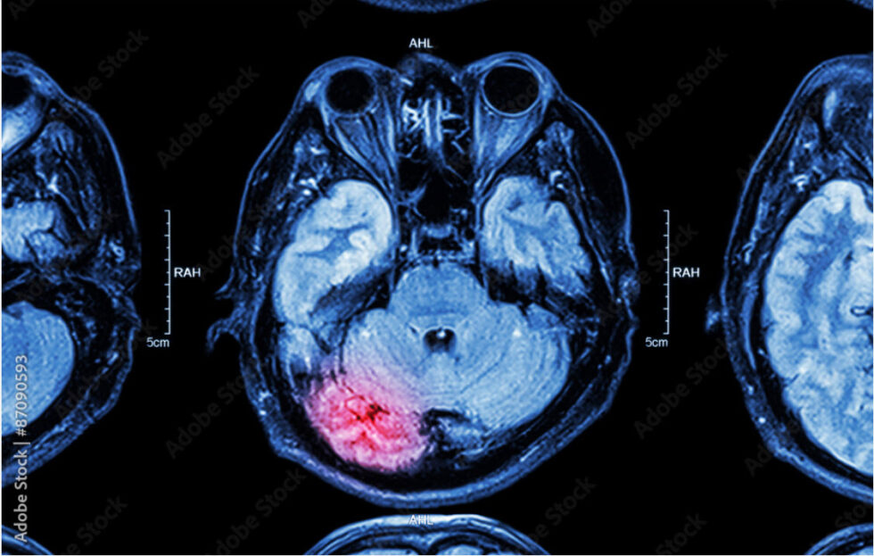 What Are the Different Types of Traumatic Brain Injury (TBI)?